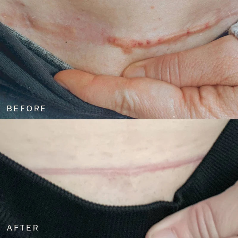 SILICONEFUSION™ C-Section Scar Patch – Private Edition Nashville